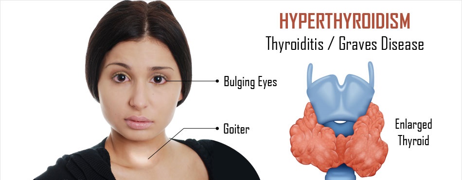 Hyperthyroidism: Recognizing the Signs – NaturWarriors