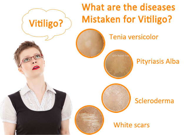 Vitiligo vs Fungus | Is it vitiligo or a fungus/yeast infection (tinea ...