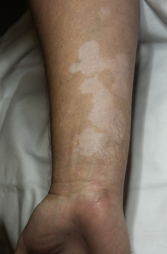 Medical Conditions That May Be Mistaken With Vitiligo – NaturWarriors