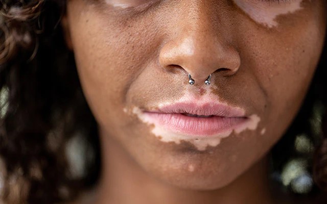 The Role of Copper in Vitiligo: A Comprehensive Review – NaturWarriors